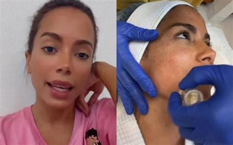 Saiba Mais Sobre O Procedimento Estético Facial Feito Pela Cantora Anitta