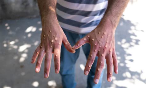 Mpox Saga Outbreaks Spread Beyond Africa Daily News