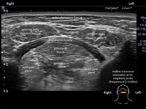 Submandibular Gland Ultrasound