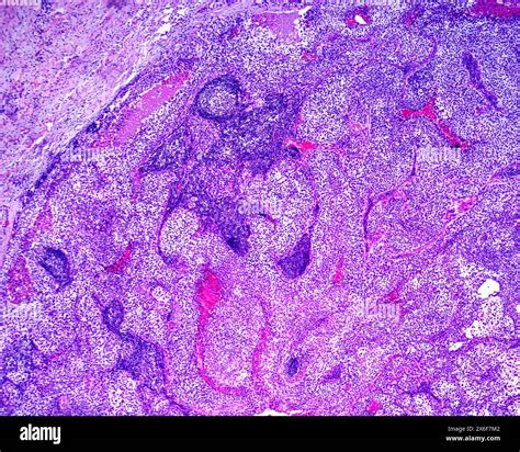 Light Micrograph Showing A Human Lymph Node Almost Completely Invaded