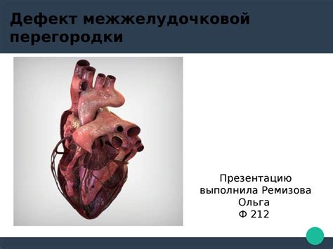 Дефект межжелудочковой перегородки Online Presentation