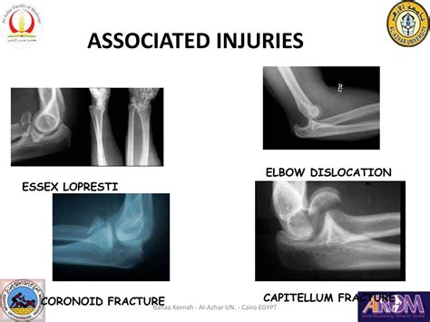 Radial Head Fracture Ppt