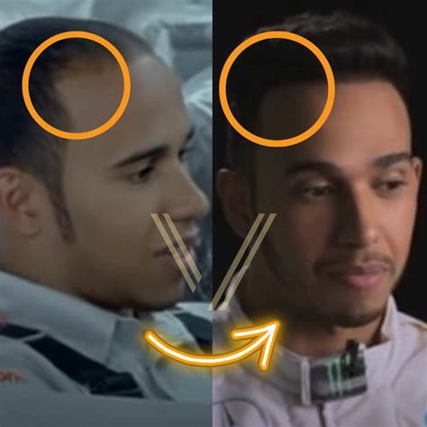 Lewis Hamiltons Hair Transplant Before And After Transformation