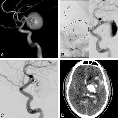 Figure 3 From Pipeline Embolization Device In Aneurysmal Subarachnoid