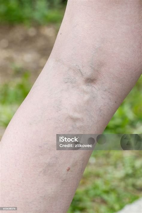 여자 고통스러운 하지정맥류의 및 모세혈관확장증 자신의 레그스 건강관리와 의술에 대한 스톡 사진 및 기타 이미지 건강관리와 의술 관다발 나이 Istock