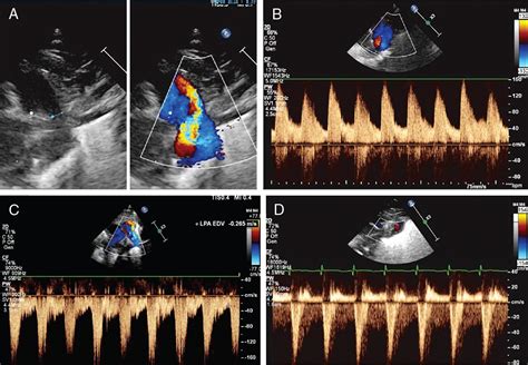Pathophysiology Based Management Of The Hemodynamically Significant