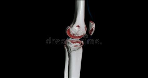 Fracture Of The Tibia Two Types Of Fracture Stock Illustration