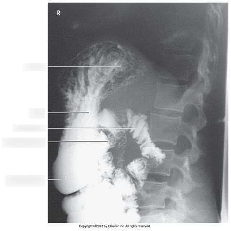 Single Contrast Right Lateral Stomach And Duodenum Diagram Quizlet