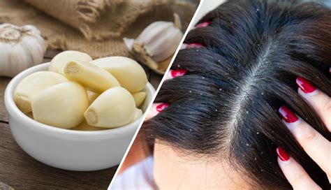 5 Diy Garlic Hair Masks To Treat Dandruff