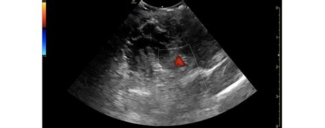 Peritonsillar Abscess Ultrasound