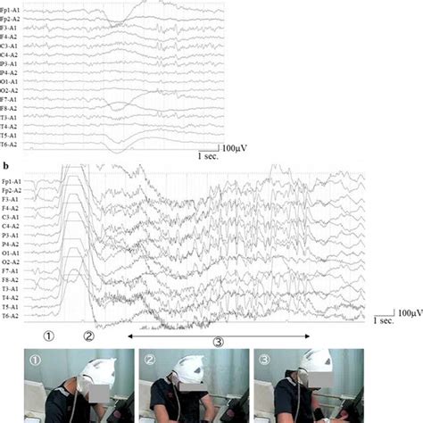 A Interictal Electroencephalography EEG At Days After The Download Scientific Diagram