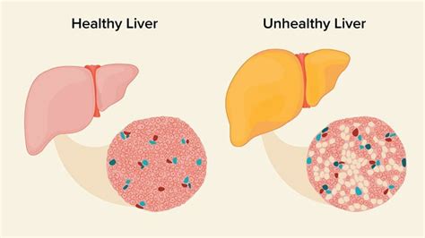 Elevated Liver Enzymes What It Is Causes Prevention And Treatment