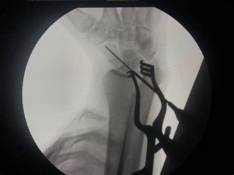 Scaphoid Proximal Pole Fracture R Radiology