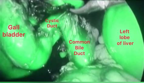 Laparoscopic Cholecystectomy Using Indocyanine Green Cholangiography