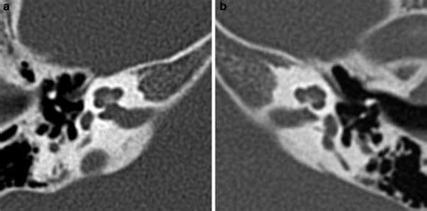 Of Cochlear Implants Radiology Key