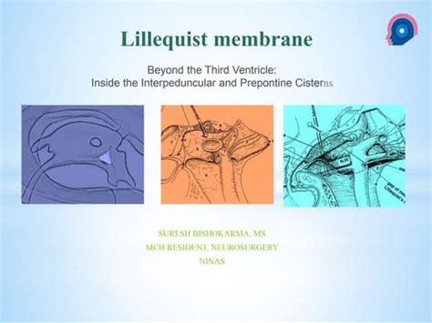 10 Interesting Myelocystocele Facts Ppt