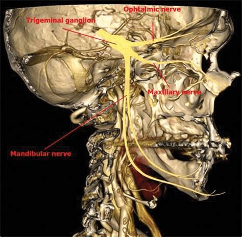 Complications Of Percutaneous Trigeminal Ganglion Procedures
