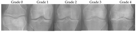 Applied Sciences Free Full Text Automatic Classification Of The Severity Of Knee