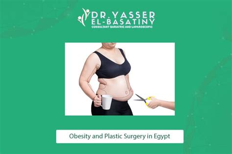 Obesity And Plastic Surgery In Egypt Dr Yasser Al Basatiny Senior