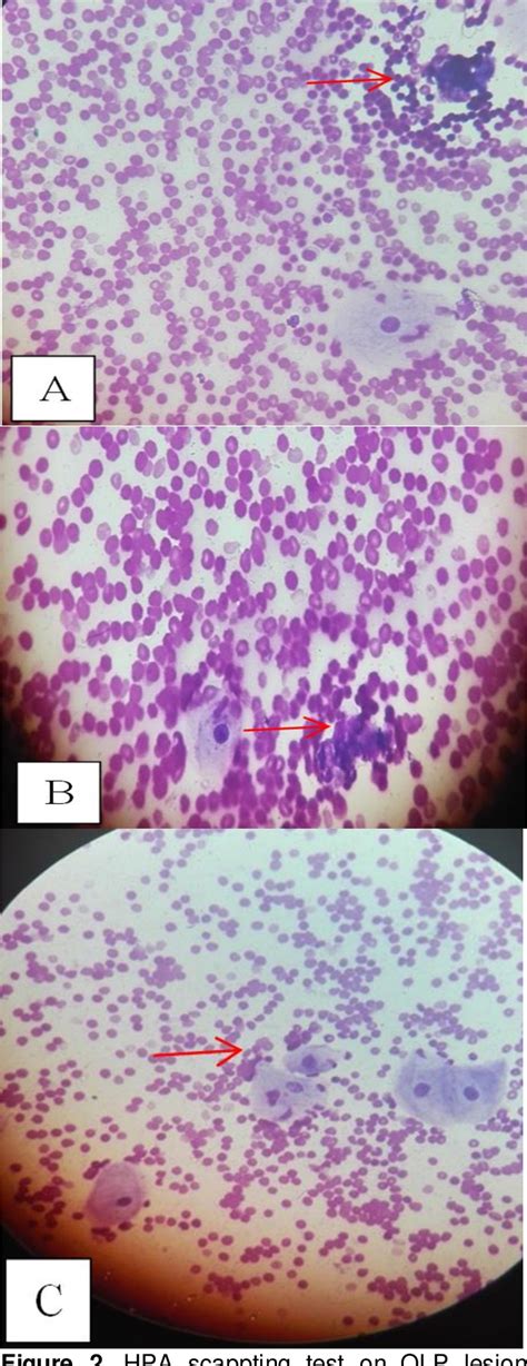 Figure 2 From Oral Lichen Planus Erosive Type A Case Report In