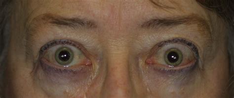 Uncovering The Truth About Thyroid Eye Disease