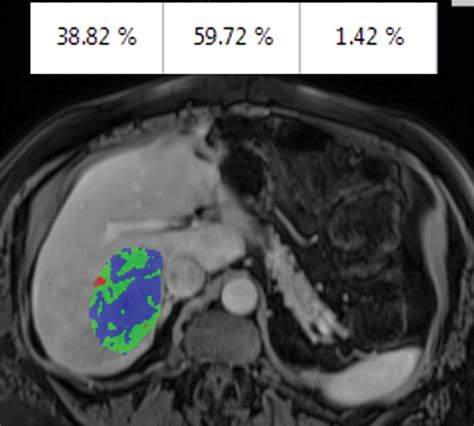 Unresectable Intrahepatic Cholangiocarcinoma Multiparametric Mr