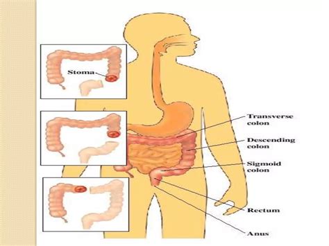 Intestinal Obstruction With Nursing Management Pptx