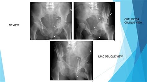 Pelvis And Acetabulum Orthopaedics Topics Slides Ppt