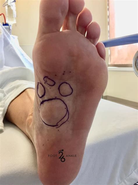 Plantar Fibroma Pictures Treatment Surgery Symptoms Plantar Fibroma