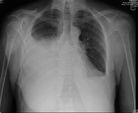 Dolor De Esternón 5 Posibles Causas ¿y Qué Hacer