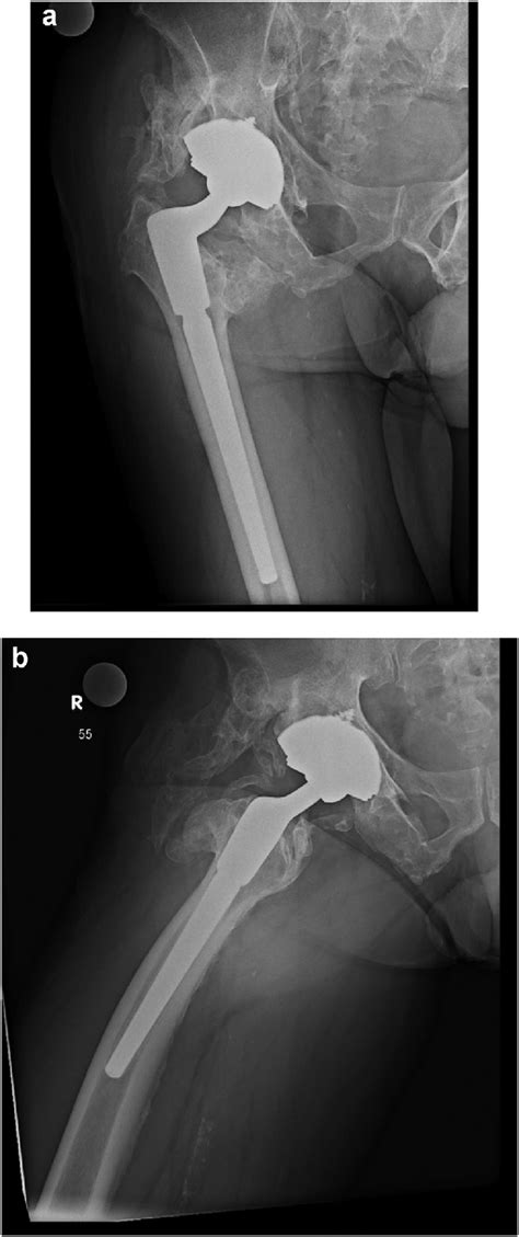 A The Final Postoperative Ap Right Hip Radiograph Following The