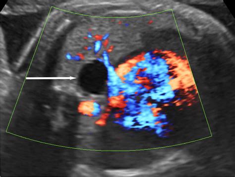 What Is Anechoic Avascular Cyst At Daniel Beaty Blog