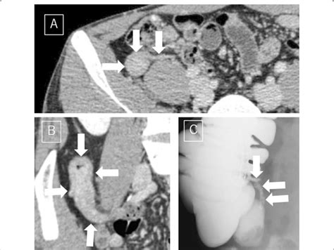 A B Enhanced Ct Revealed An Enlarged And Diffusely Thickened Appendix Download Scientific