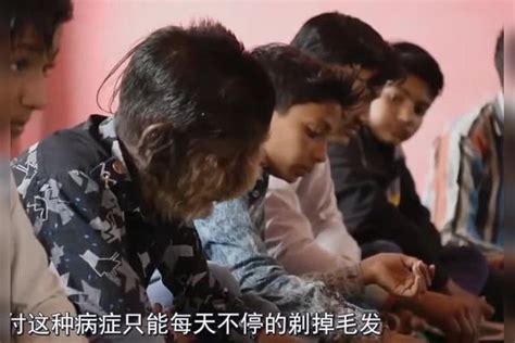 印度男孩原始基因被激活全身长毛的狼人综合症医生束手无策