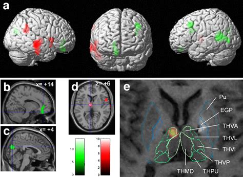 Subthalamus Mri
