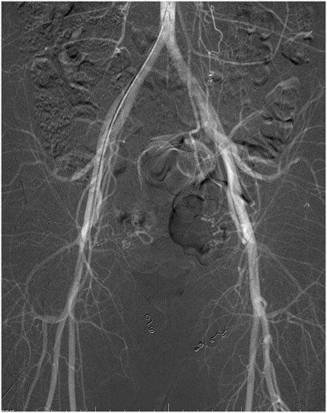 Follow Up Angiography Performed 3 Months After Trans Arterial