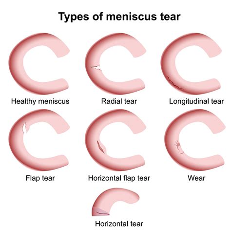 Meniscus Diagram