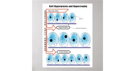 Hyperplasia And Hypertrophy Comparison Chart Poster Zazzle