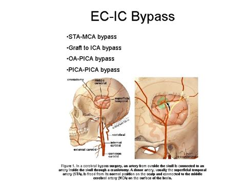 Intracranial Ptastenting Ecic Bypass Stamca Bypass Graft To