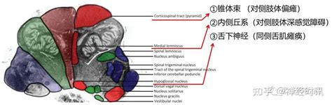 双侧延髓内侧梗死所致呼吸衰竭【解剖、影像、临床】 知乎