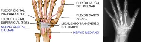 Lesión Fibrocartílago Triangular O Fct Meds