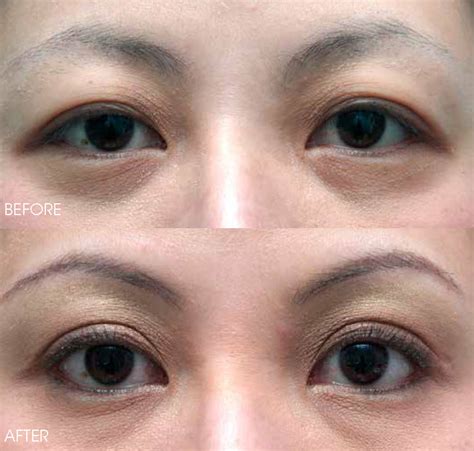 How Much Does It Cost To Have Eye Bag Removal Surgery At William