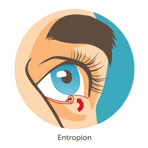 Entropion Ectropion Visum