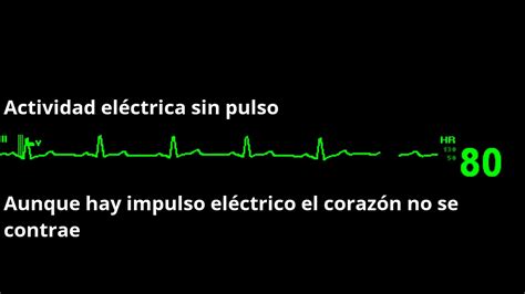 Atividade Elétrica Sem Pulso Retoedu