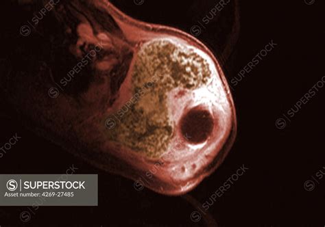 Shoulder Chondrosarcoma Axial Mri Of The Shoulder Showing A
