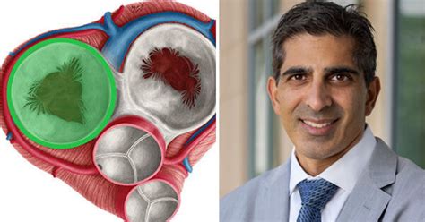 Surgeon Qanda Tricuspid Valve Surgery With Pacemakers