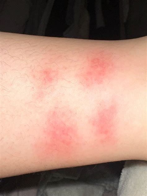 모기 물린 자국 맞나요 지식in