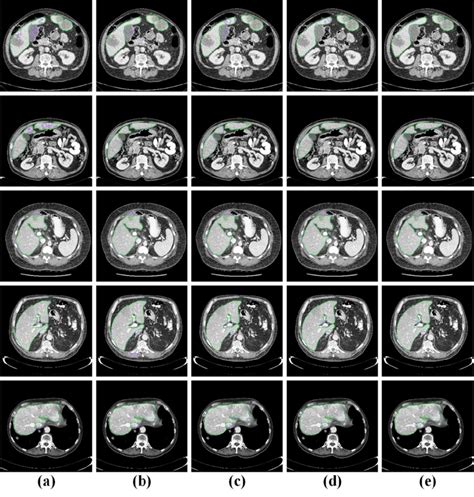 Visualization Of Challenging Cases A Fcn B U Net C Attention