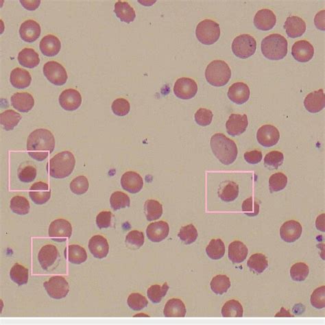 Peripheral Blood Smear 100x Image 2 Peripheral Blood Smear Showing