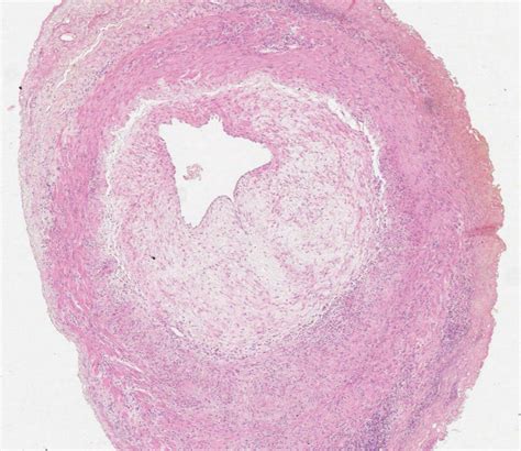 Intimal Thickening GCA Histology
